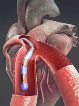 Study: Overcoming cardiovascular disease with a magnetically-steerable ...